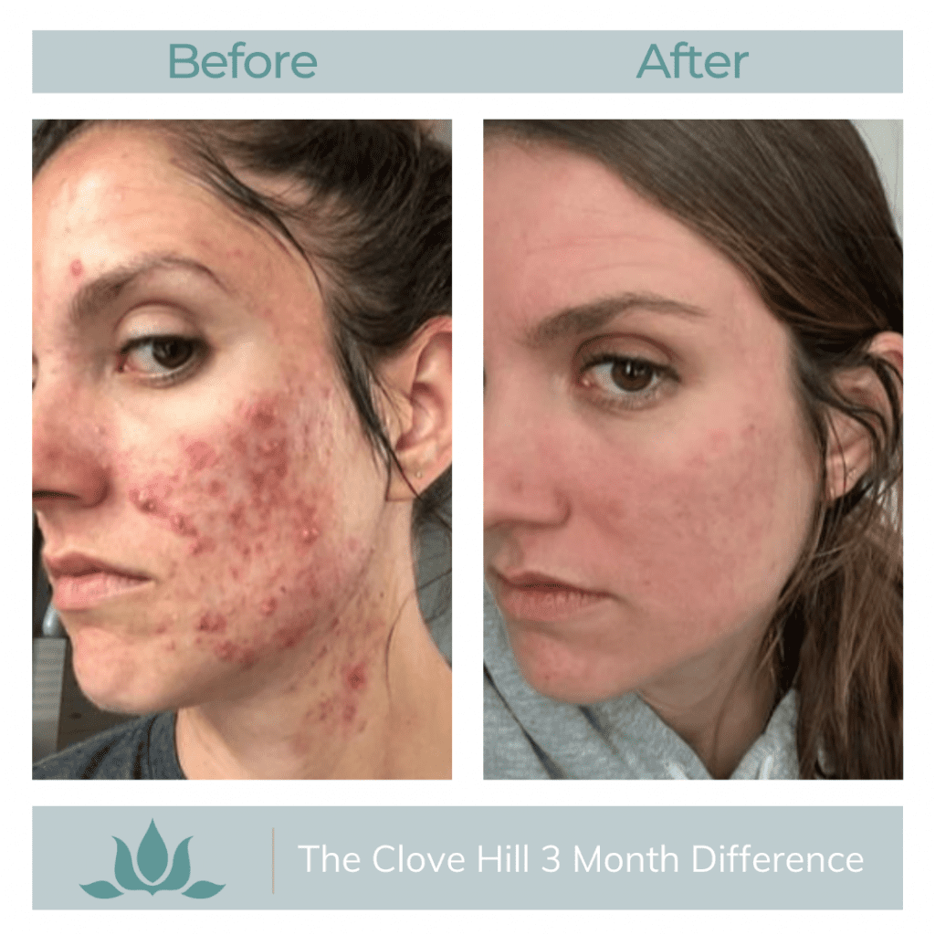 Clove Hill Balancing Lotion: Acne-Safe Moisturizer for Glow & Balance