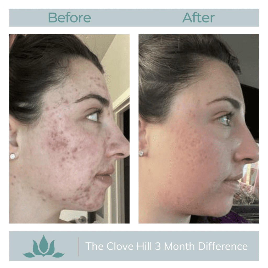 Clove Hill Vitamin A Serum II: Clear Acne & Revive Skin