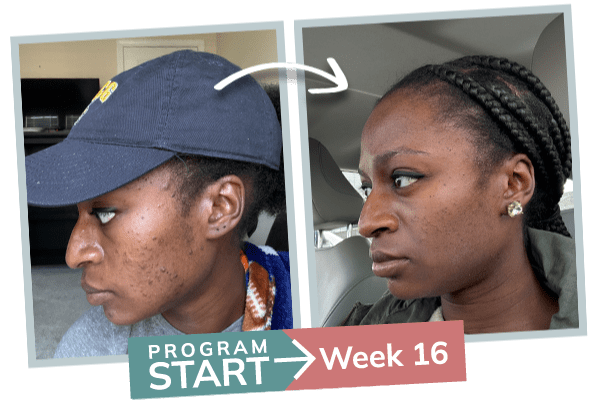 Clear Skin Breakthrough Session | Booking | Natural Acne Clinic