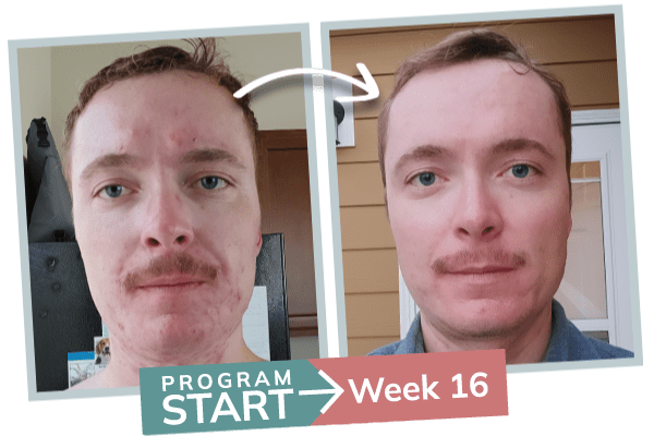 Clear Skin Breakthrough Session | Booking | Natural Acne Clinic